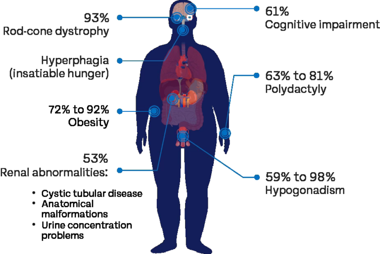 Diagnosing Bardet-Biedl Syndrome - Rhythm Pharmaceuticals HCP Site